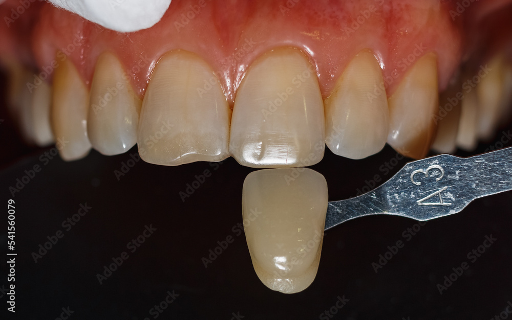 Determination of tooth color using a sample on a black background ...