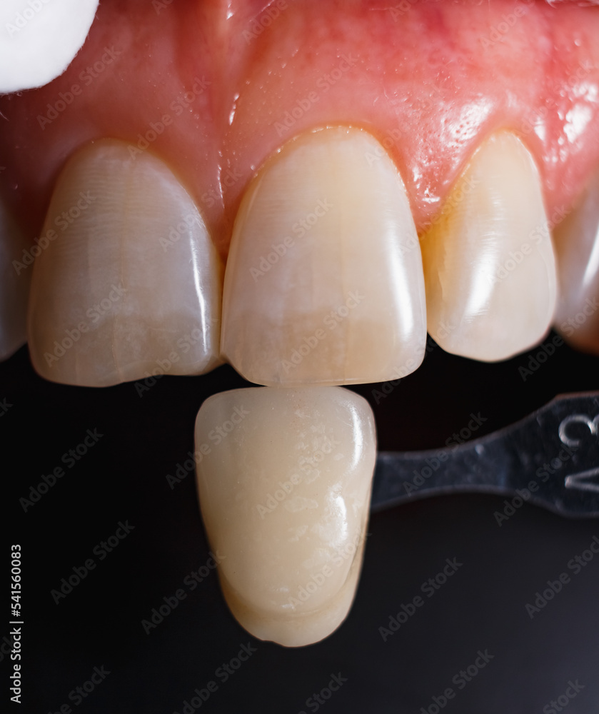 Determination of tooth color using a sample on a black background ...