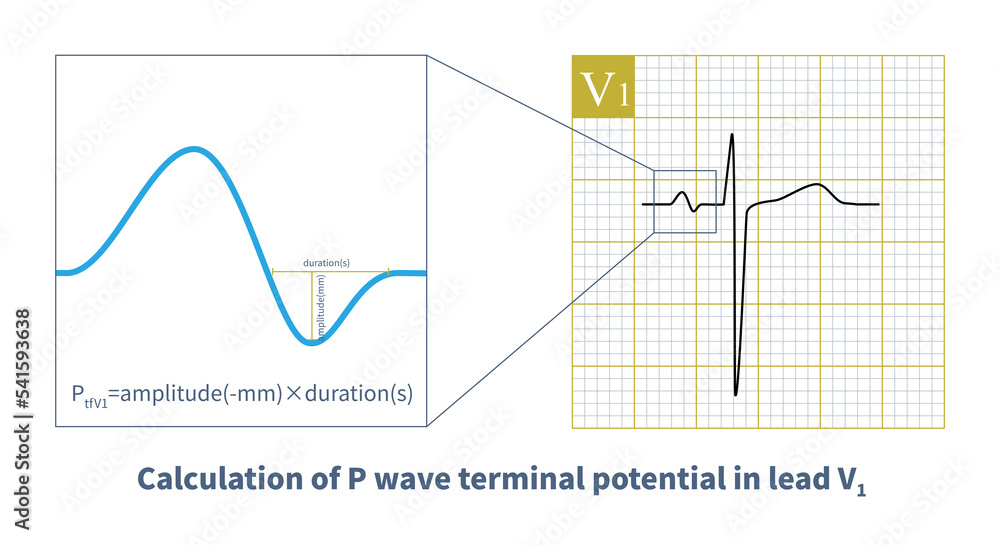 The negative part of P wave in lead V1 carries the electrical ...