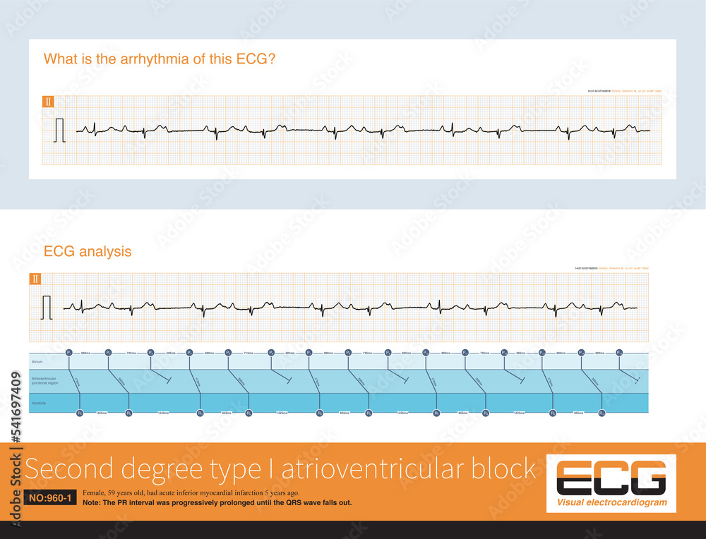 In second degree type I atrioventricular block, the PR interval is ...