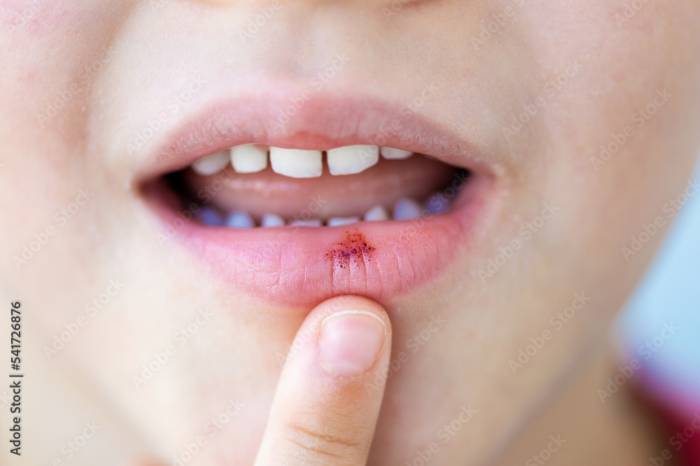 Child have Aphthous ulcer or Canker sore on mouth at lip foto de Stock ...