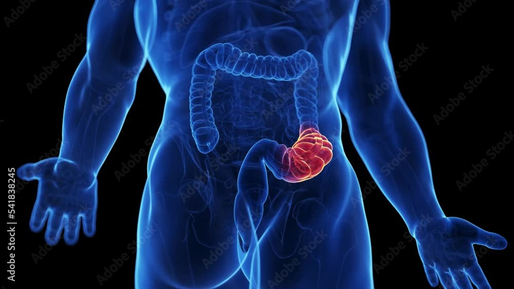 3d rendered medical animation of a constipation Stock Video | Adobe Stock