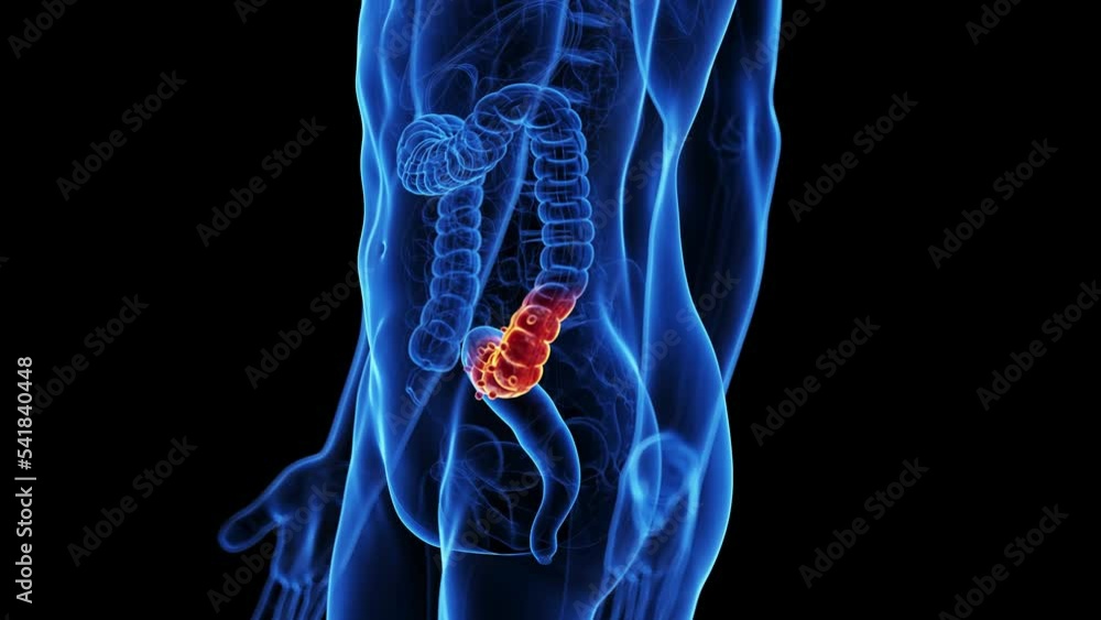 3d rendered medical animation of a man suffering from diverticulitis ...