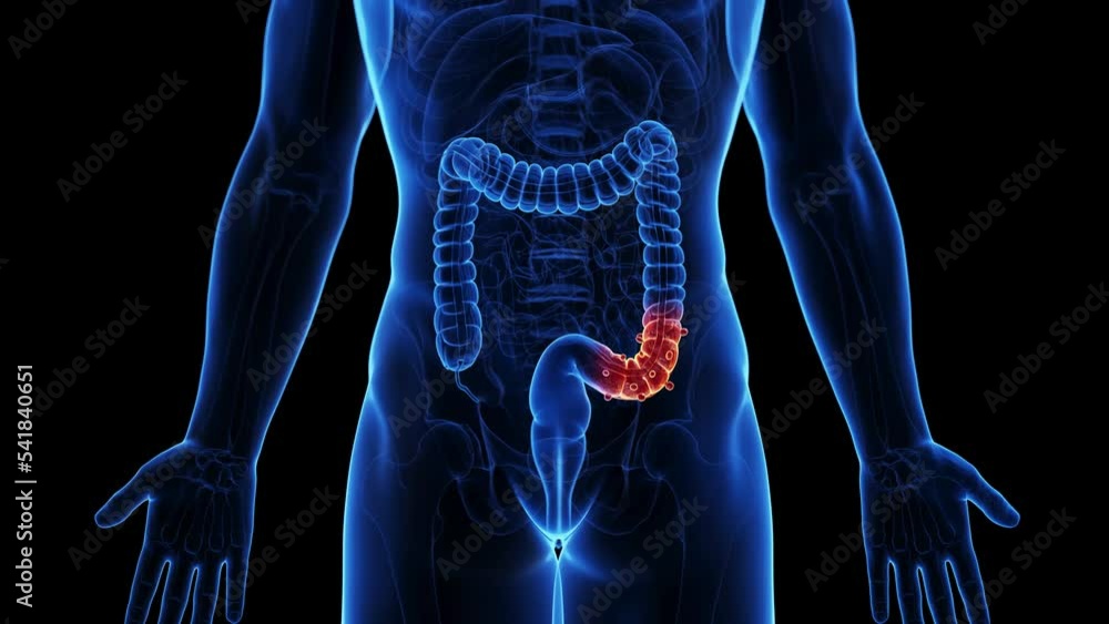3d rendered medical animation of a man suffering from diverticulitis ...