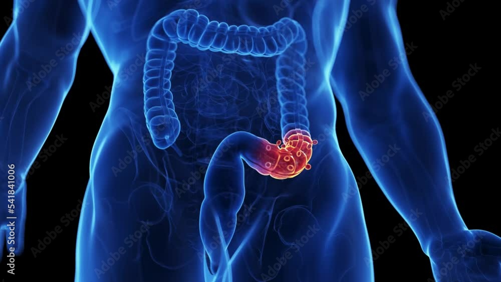 3d rendered medical animation of a man suffering from diverticulitis ...