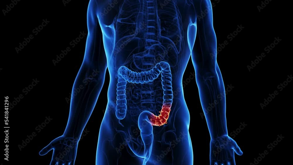 3d rendered medical animation of a man suffering from diverticulitis ...