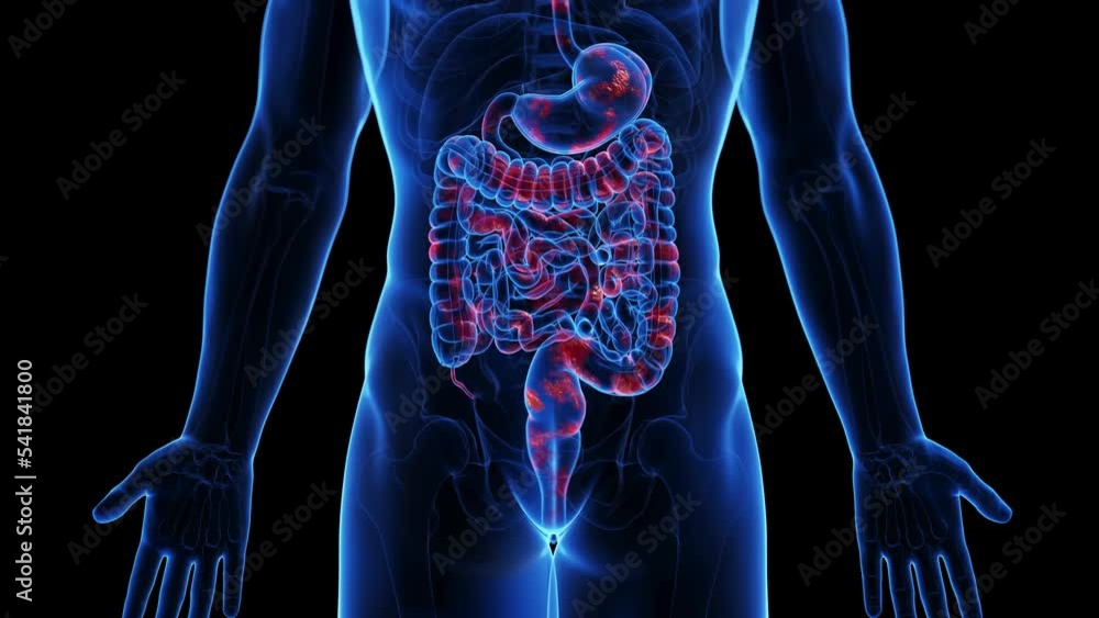 3d rendered medical animation of the colon of a man suffering from ...