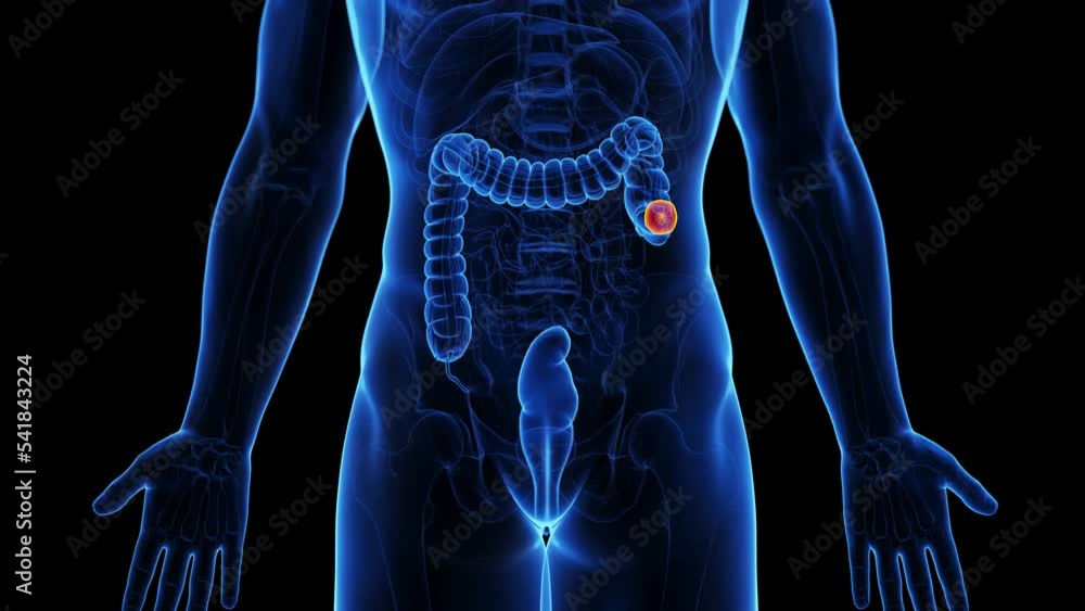 3d rendered medical animation of a colectomy Stock Video | Adobe Stock