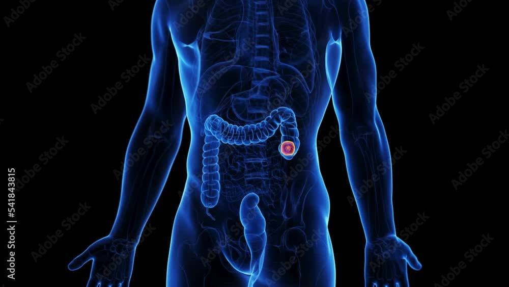 3d rendered medical animation of a colectomy Stock Video | Adobe Stock