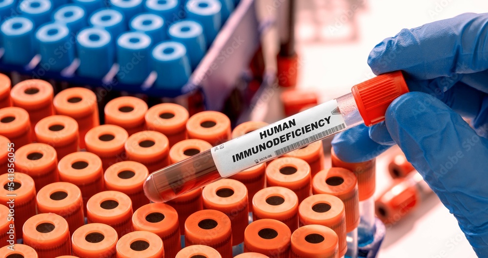 Human Immunodeficiency Virus Test tube with blood sample in infection ...