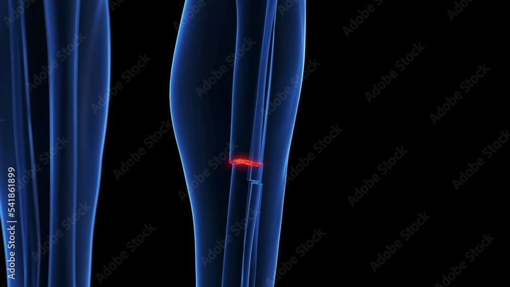 3d rendered medical animation of a broken tibia Stock Video | Adobe Stock