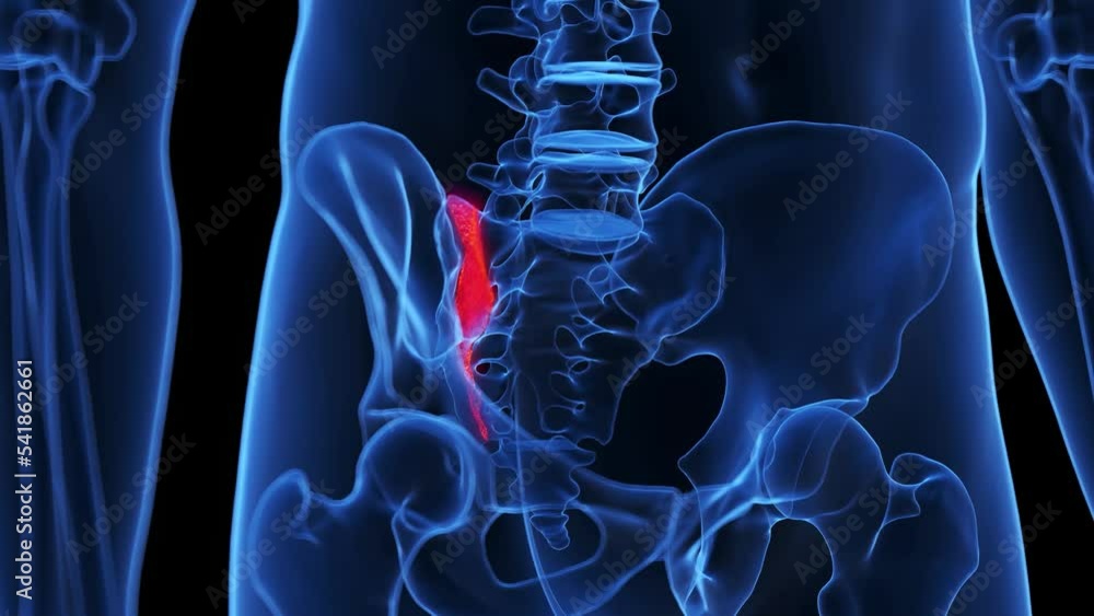 3d rendered medical animation of a broken sacrum Stock Video | Adobe Stock