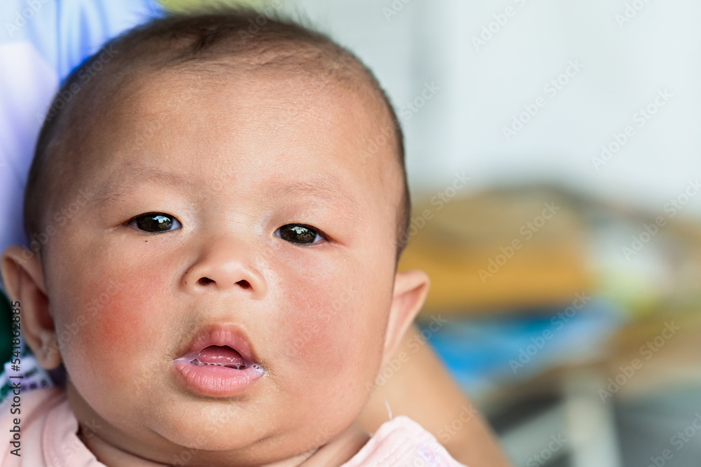 rash on baby face, baby with dermatitis problem of rash. Allergy ...