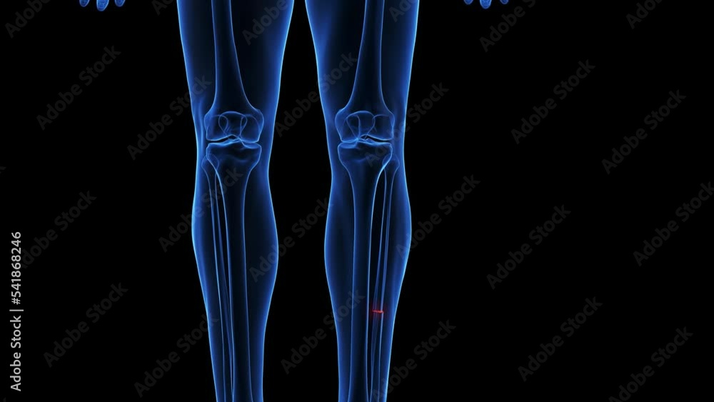 3d rendered medical animation of a broken lower leg Stock Video | Adobe ...