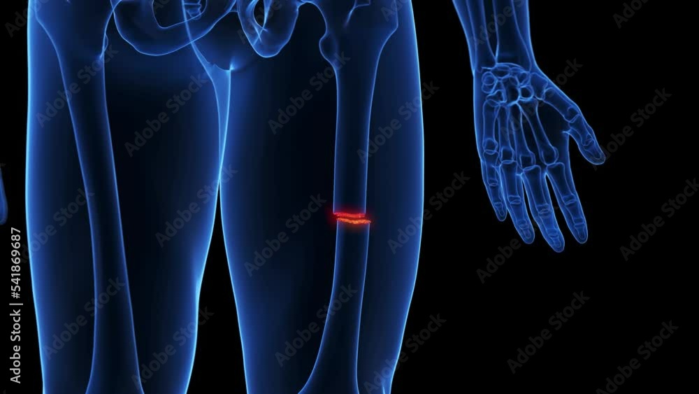 3d rendered medical animation of a broken upper leg Stock Video | Adobe ...
