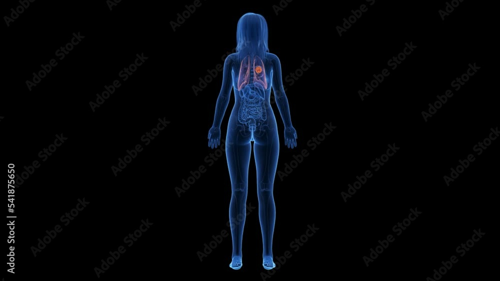 3d rendered medical animation of a lung tumor Stock Video | Adobe Stock
