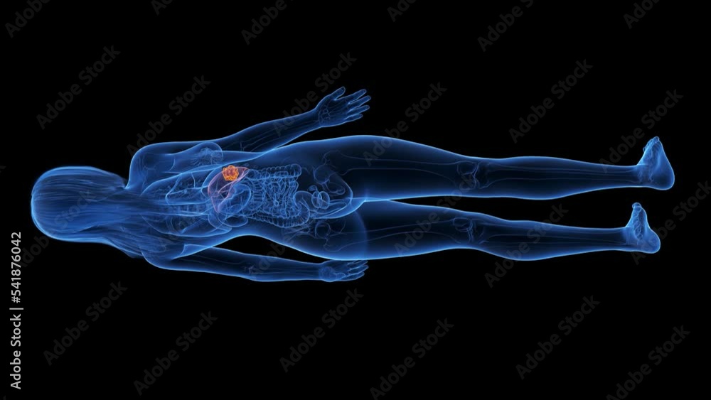 3d rendered medical animation of a liver tumor Stock Video | Adobe Stock