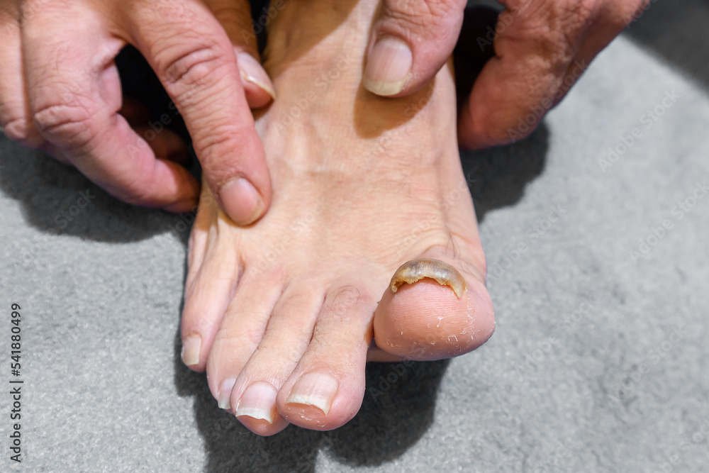 big toe of a person suffering from onychomycosis, a fungal infection ...
