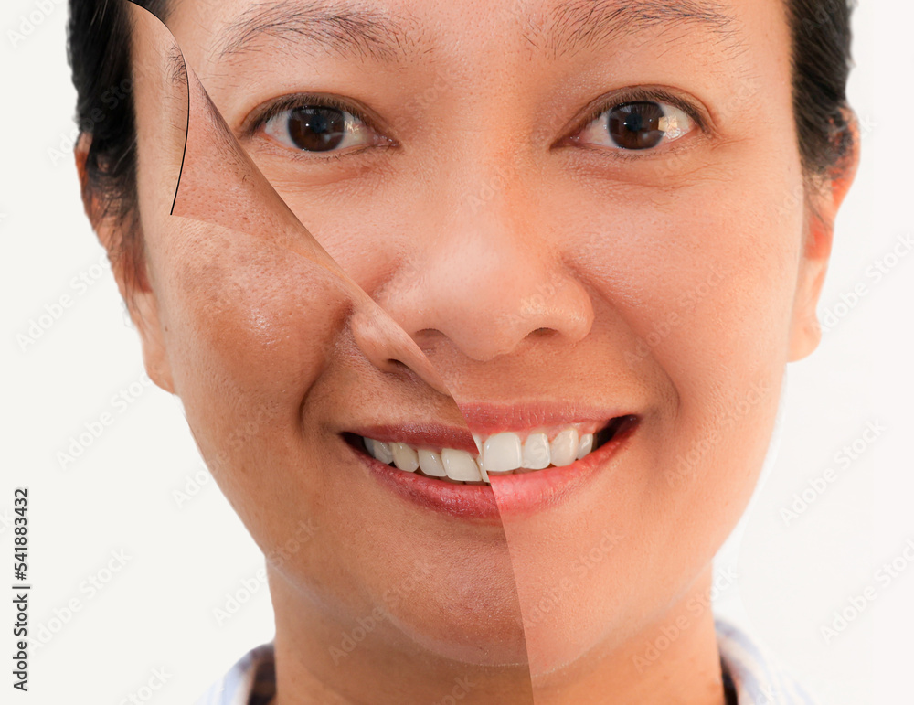 Retouched image to show before and after treatment spot melasma ...