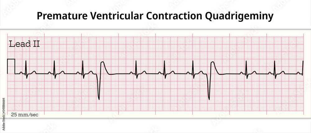 Poster ECG Premature Ventricular Contraction Trigeminy - 8 Second ECG ...