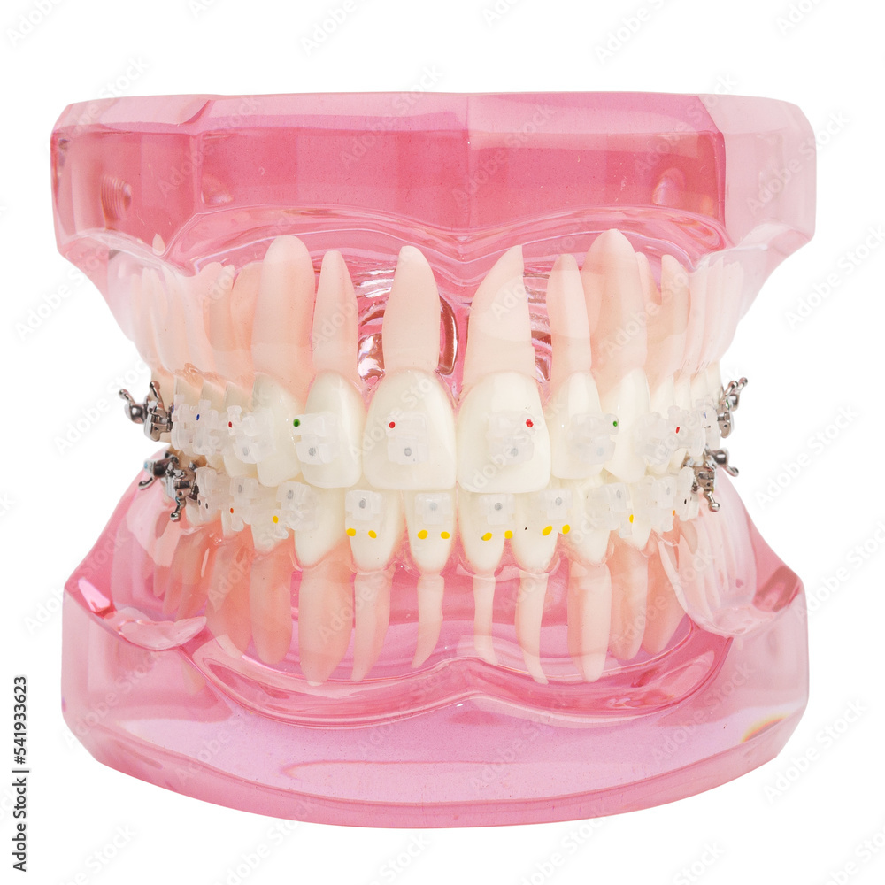 Demonstration teeth with roots model of orthodontic bracket or brace ...