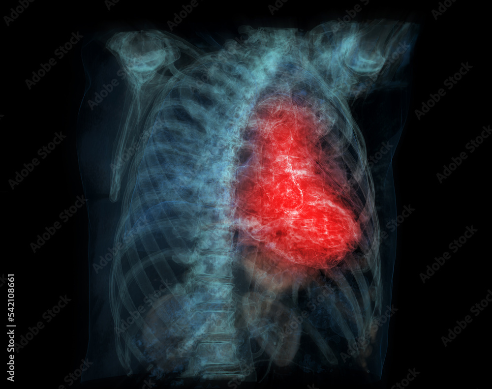 Human heart attack pain as an anatomy medical disease concept with a ...