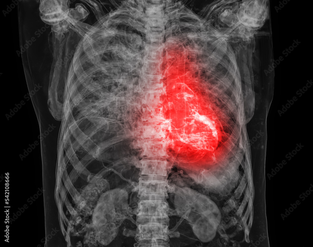 Human heart attack pain as an anatomy medical disease concept with a ...