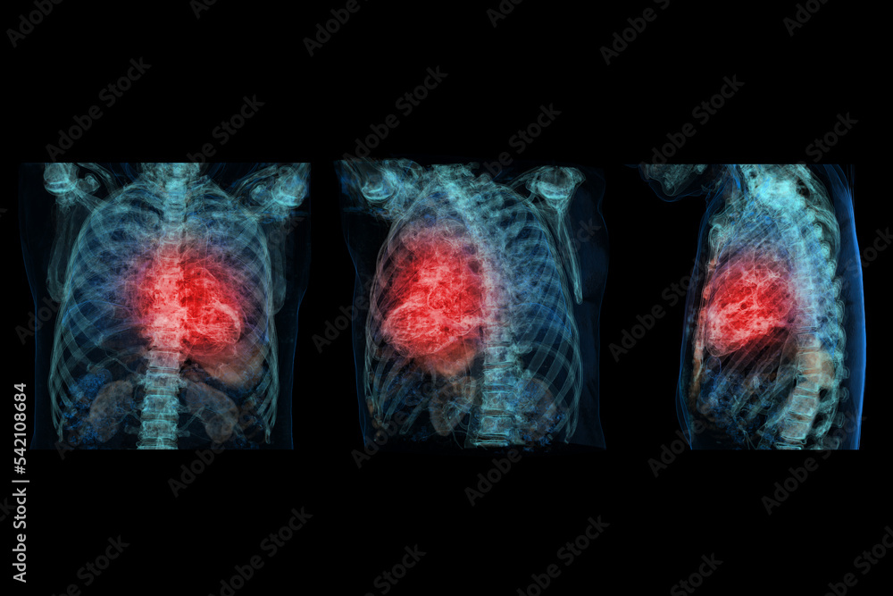 Human heart attack pain as an anatomy medical disease concept with a ...