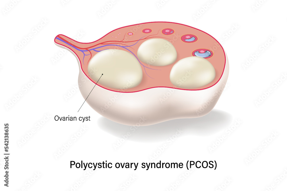 Polycystic Ovary Syndrome Pcos Cross Section Vector Ovarian Cysts 2234