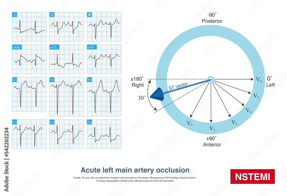 When extensive ST segment depression occurs, the most important ...