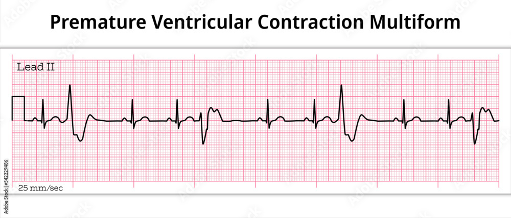 Poster ECG Premature Ventricular Contraction Multiform / Multifocal - 8 ...