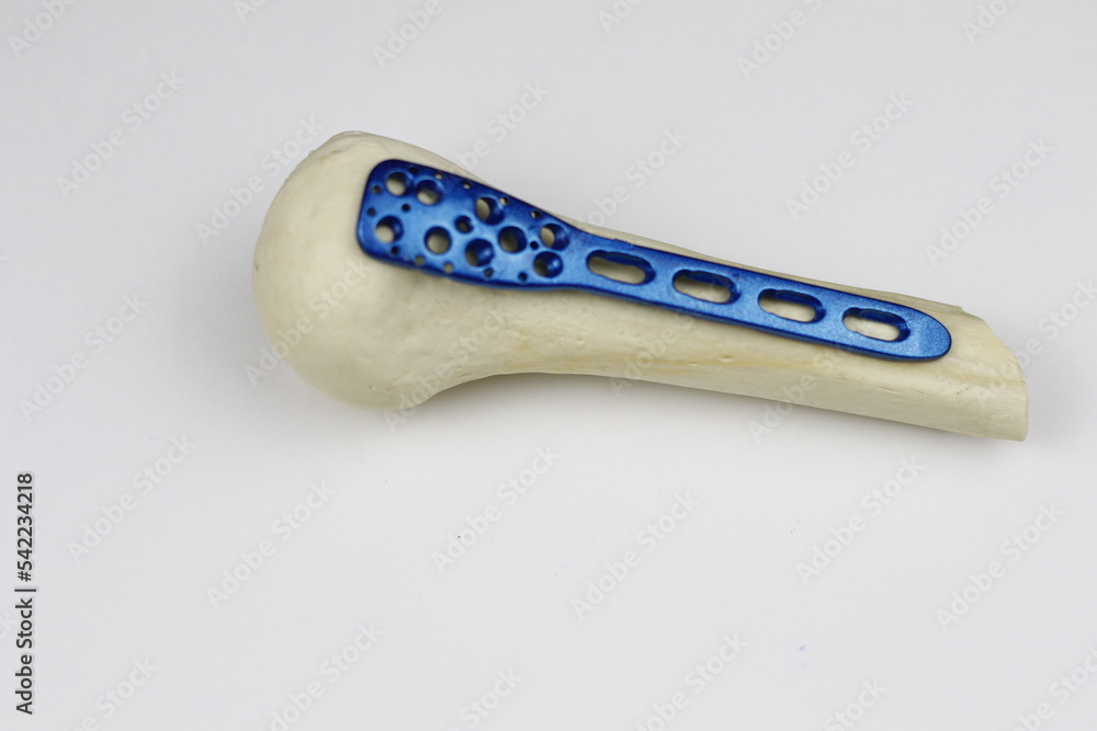 Surgical plates and instruments for osteosynthesis of bone fractures ...