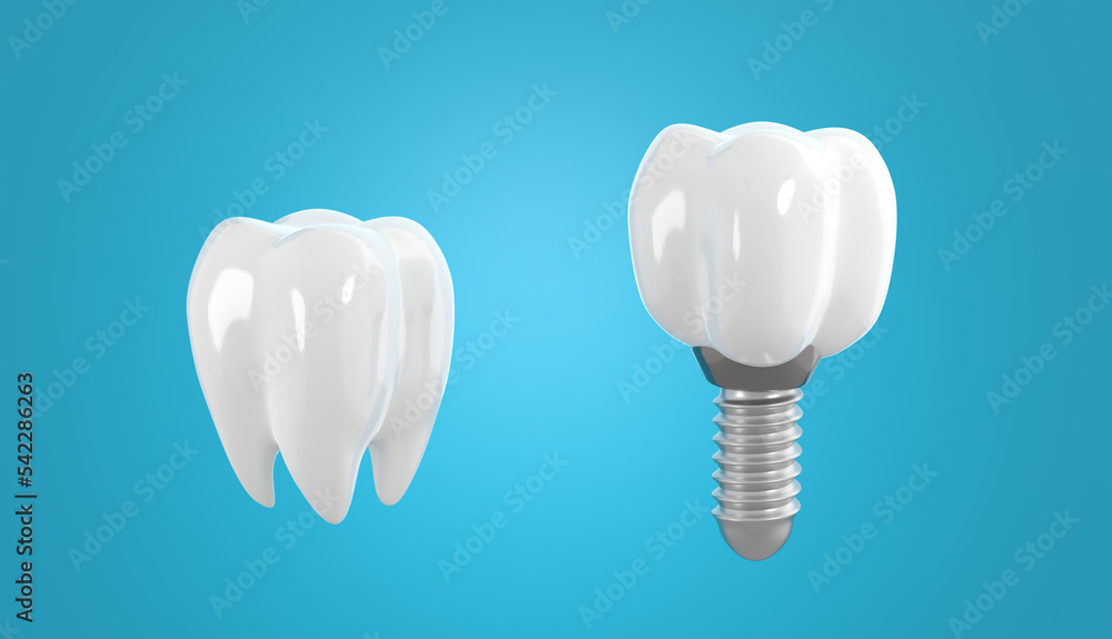 Dental implant new natural teeth 3d render illustration. Construction ...