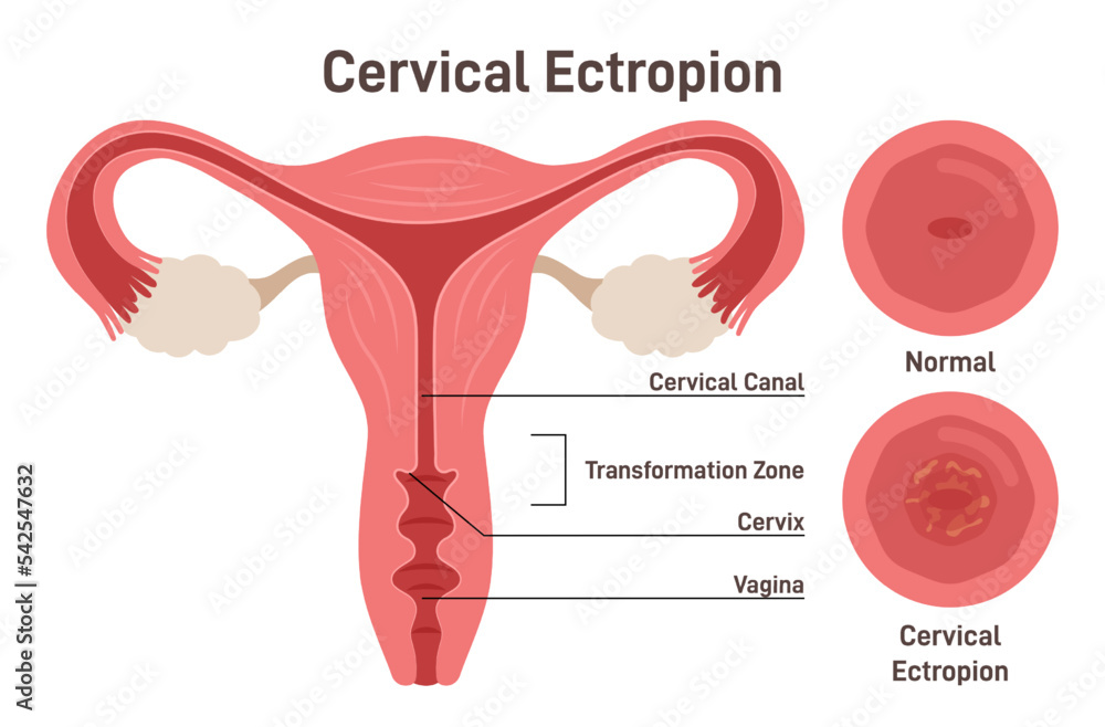 Vektorová grafika „Cervical ectropion or erosion. Cervical canal cells extend on to the surface ...