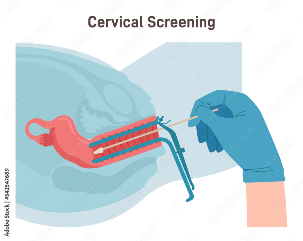 Cervical screening, gynecological examining concept. Cervix cancer Stock Vector | Adobe Stock
