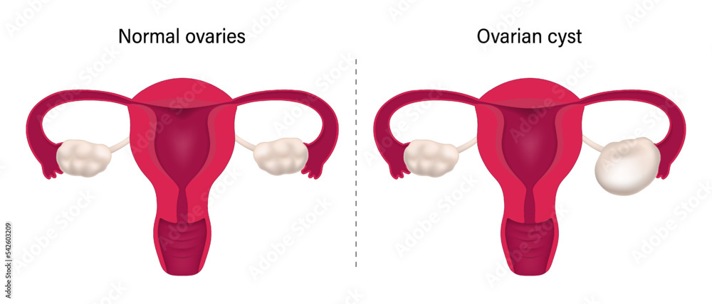 Ovarian cyst. Comparison of normal ovaries and cystic ovaries. Female reproductive system. Stock ...