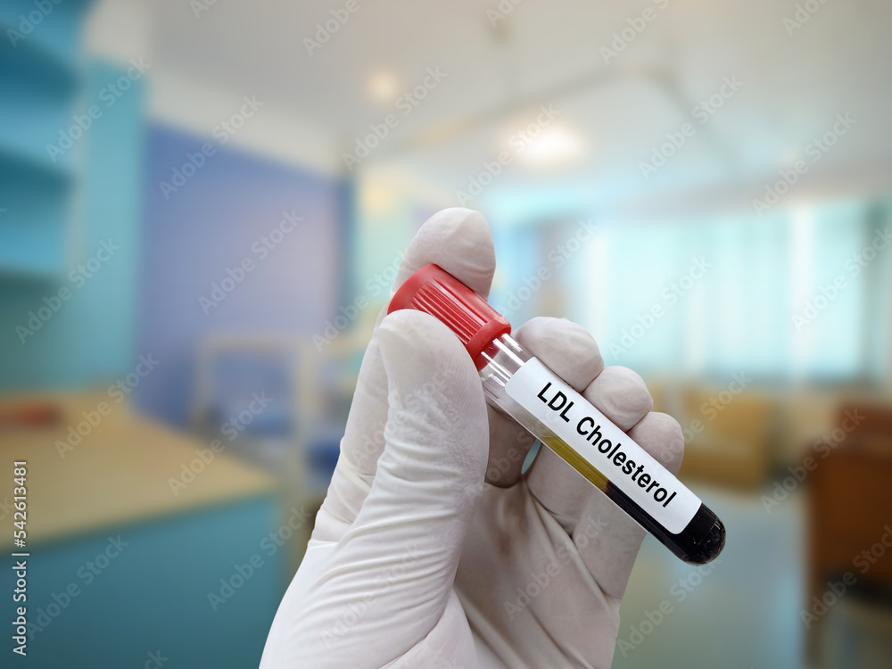 Scientist holds blood sample for Ldl cholesterol test with patient bed ...