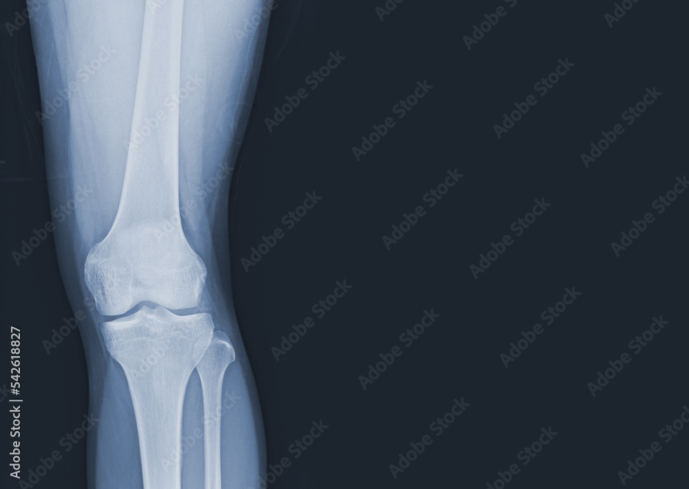 Film x-ray of human knee normal joints and ligaments Medical image ...