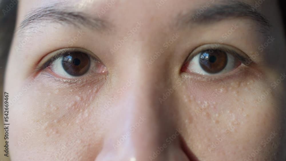 Syringoma milia milium cysts or seborrheic keratosis on asia people ...