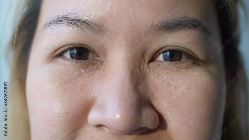 Syringoma milia milium cysts or seborrheic keratosis on asia people ...