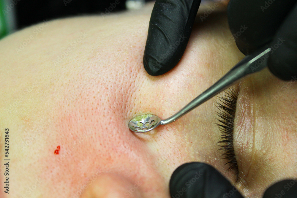 cosmetology. facial skin pollution disappears. clogged sebaceous glands ...