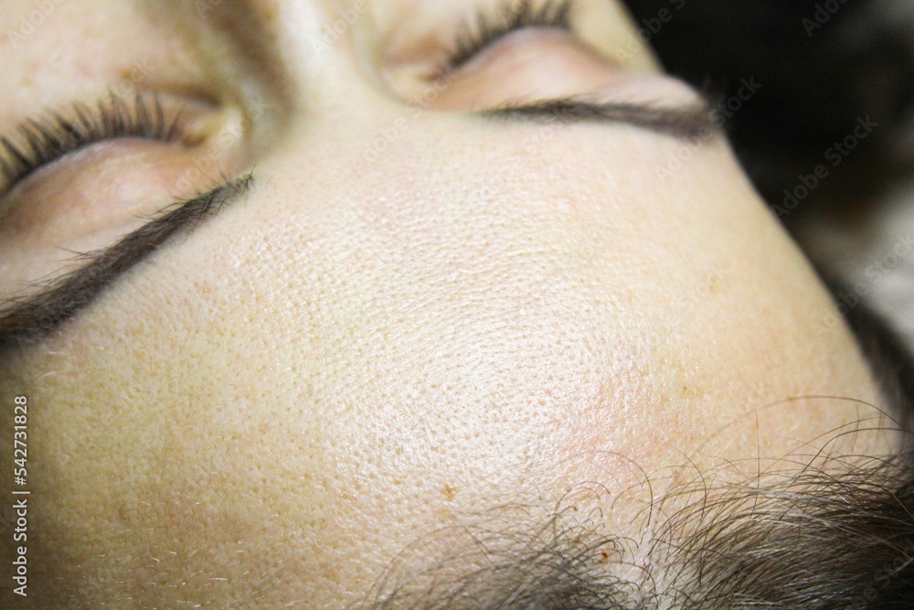 cosmetology. facial skin pollution disappears. clogged sebaceous glands ...