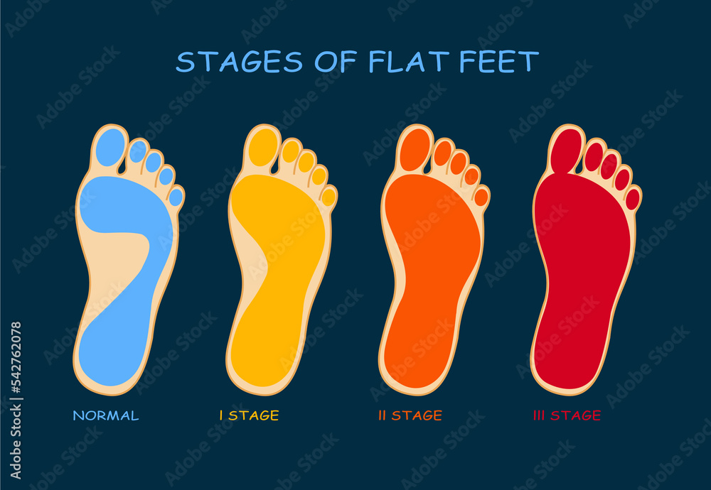 Stages of flat feet. Deformation of the foot. Stock Vector | Adobe Stock