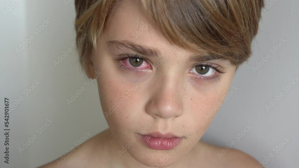 Close up face of teenager boy with red inflamed irritated eye burst ...