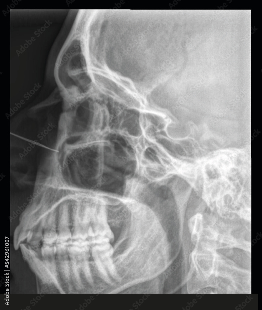 Face x-ray. Radiography lateral view of a womans face Stock Photo ...