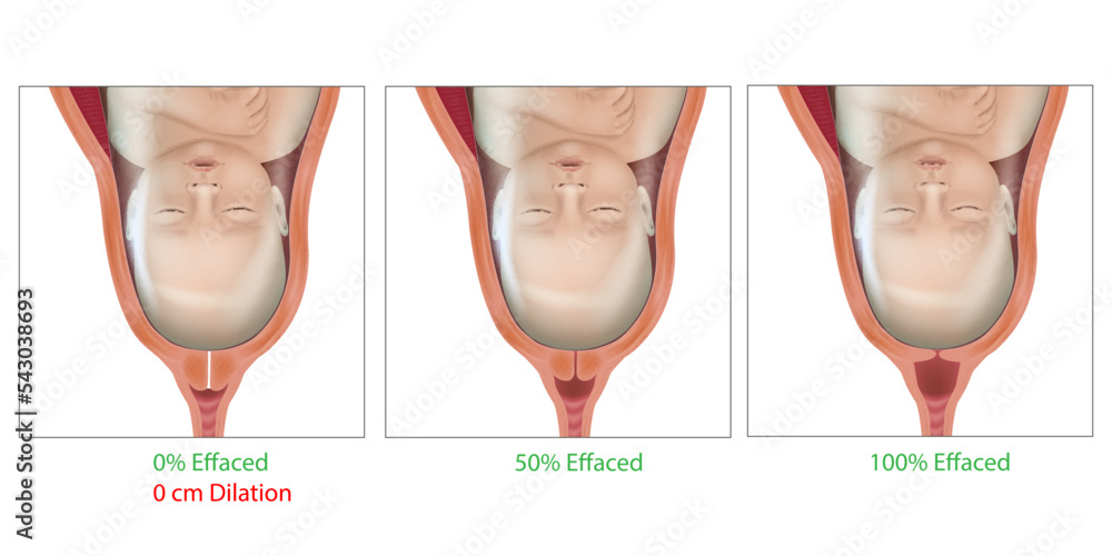 Cervical Effacement Causes Measuring What It Means 58 OFF
