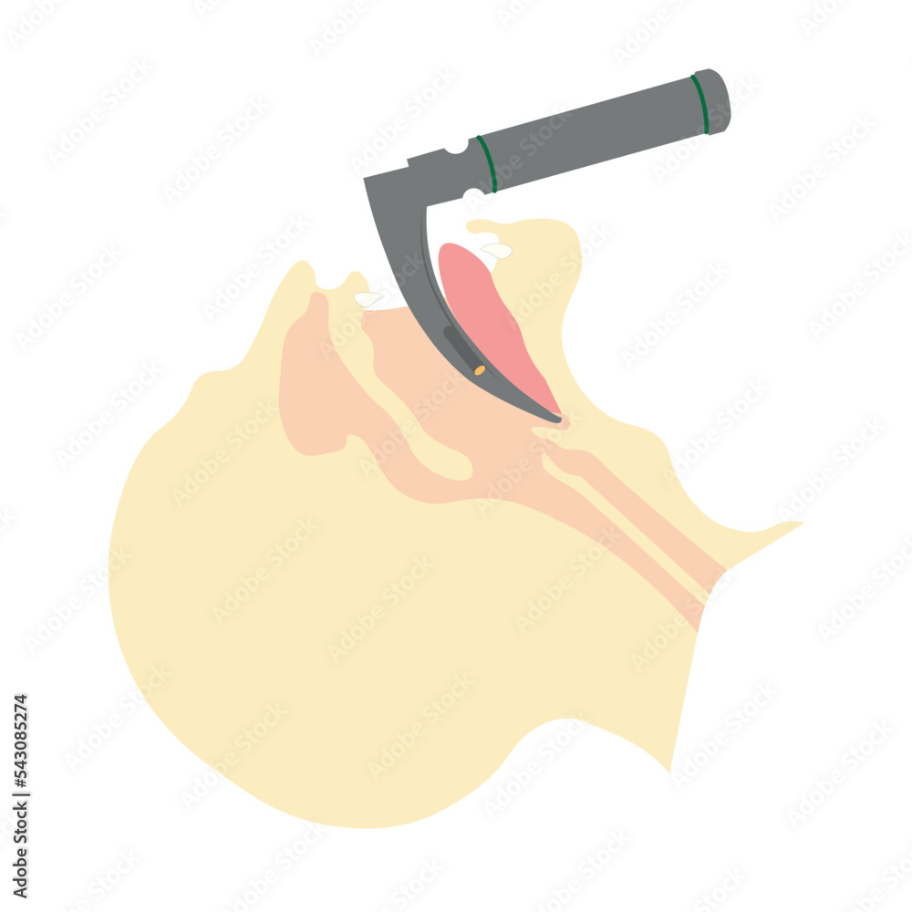 Airway managment illustration. Intubation with laryngoscopy. vector de ... Airway managment illustration. Intubation with laryngoscopy. vector de ...