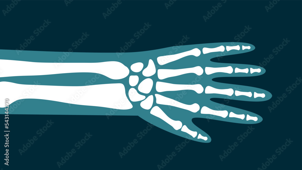 X-ray image of the hand Stock Vector | Adobe Stock