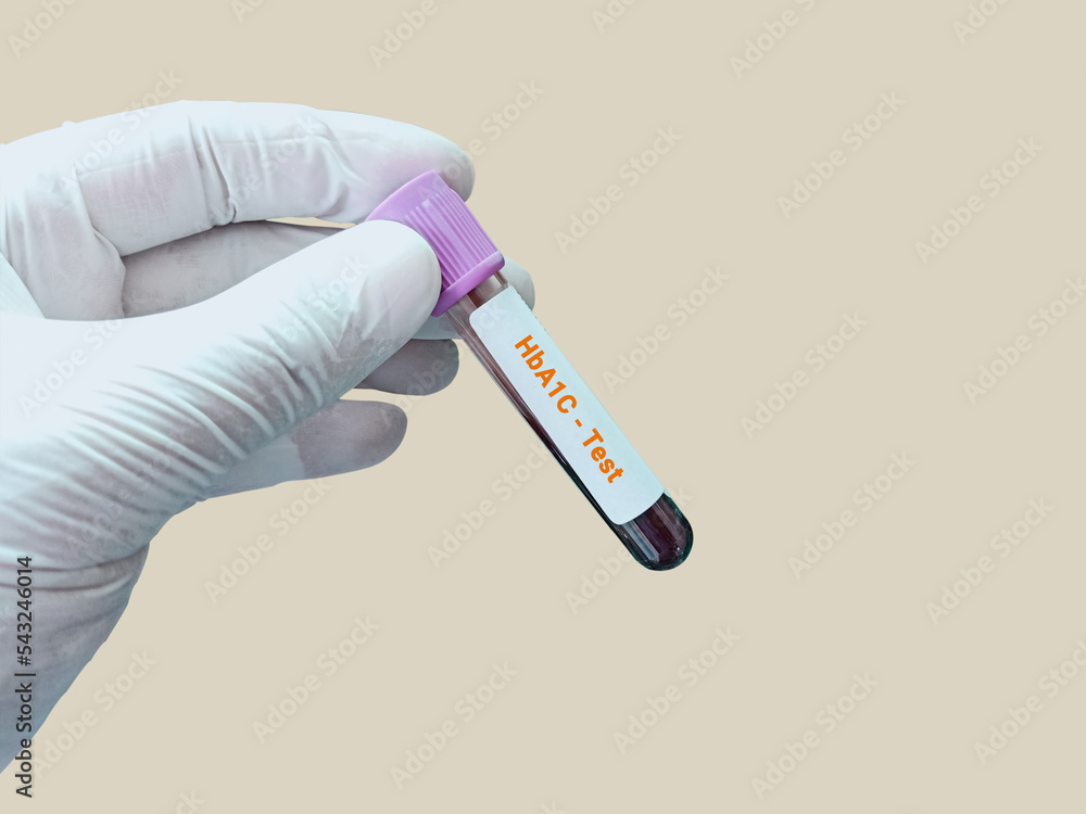 Lab Technologist holds blood sample for HbA1C test, diabetes diagnosis ...