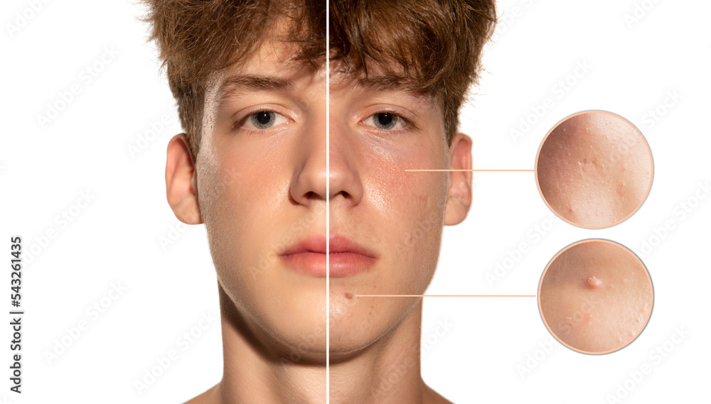 Oily skin problem - acne, blackhead, pustule, papule, enlarged pores ...